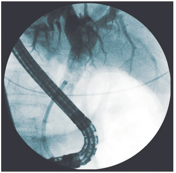 Figura 3. Colangiografía bloqueada que evidencia ausencia de litiasis ...